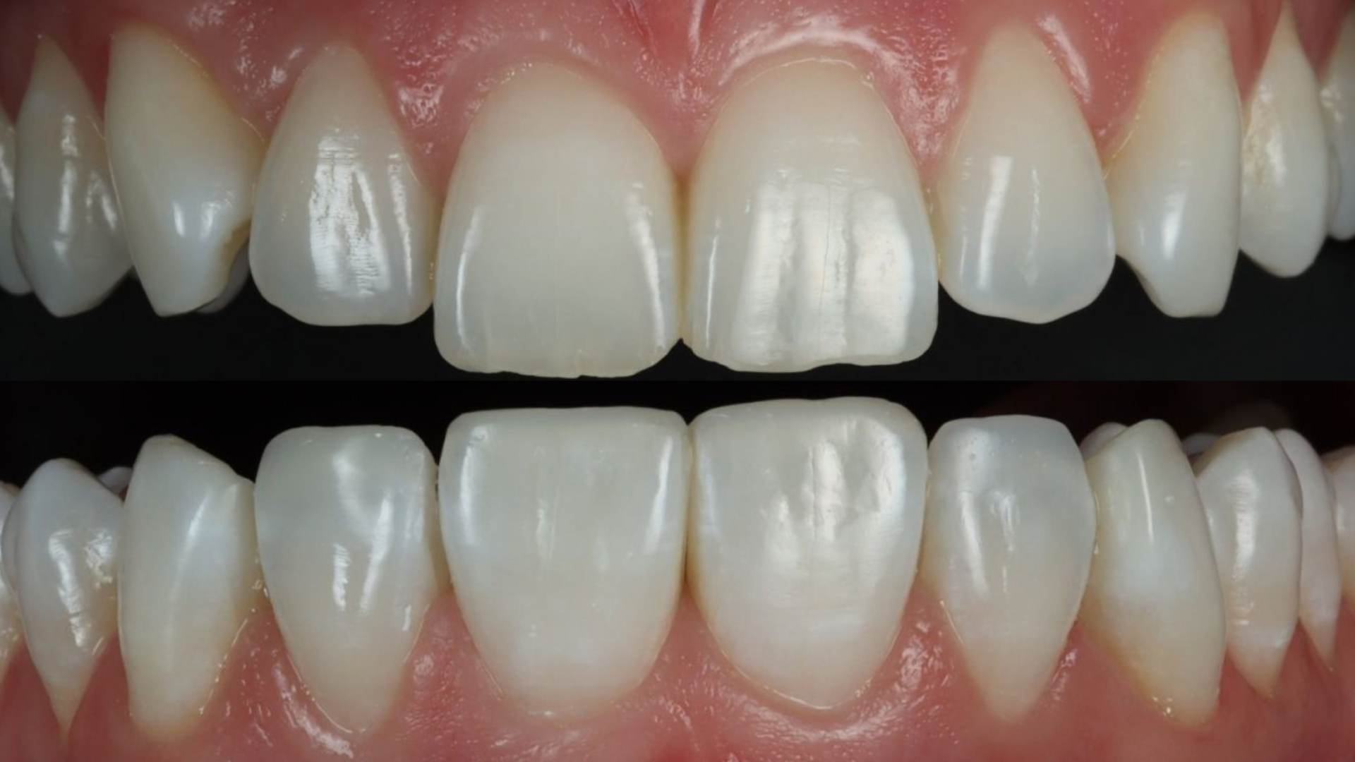 Correct Tooth Imperfections with Composite Bonding - enhance